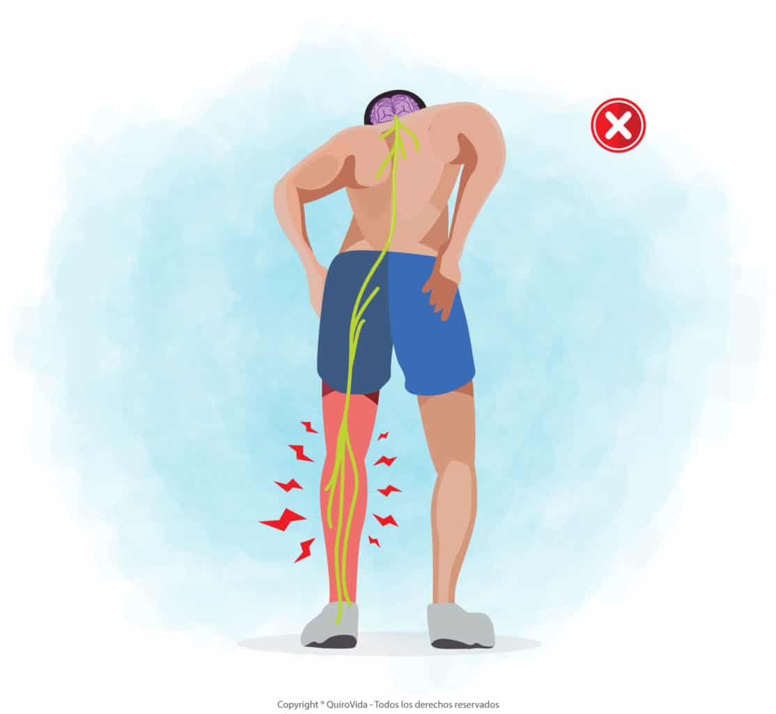 Síntomas y causas de la Ciática (Nervio Ciático) - QuiroVida Centro ...
