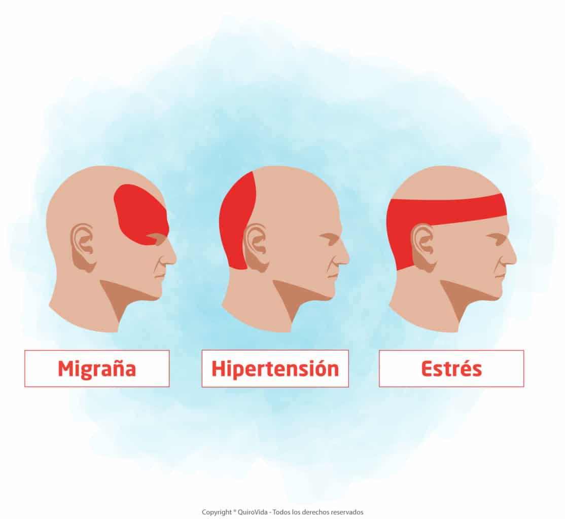 Síntomas y causas del dolor de cabeza - QuiroVida Centro Quiropráctico